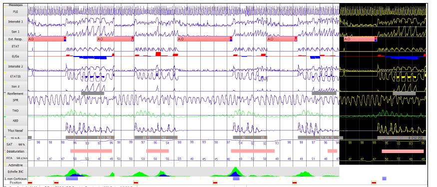 Polygraphie ventilatoire - Pour vous aider à mieux dormir
